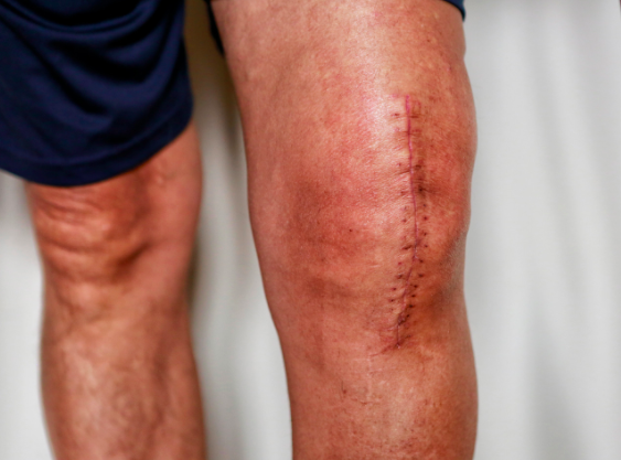 ACL surgery and scarring. How long will my ACL scar last?